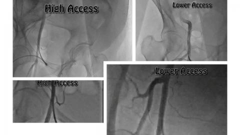 Safe Femoral Access: Using All the Tools in the Toolbox | SCAI